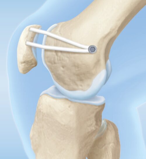 Knie – Stabilisation – GZW