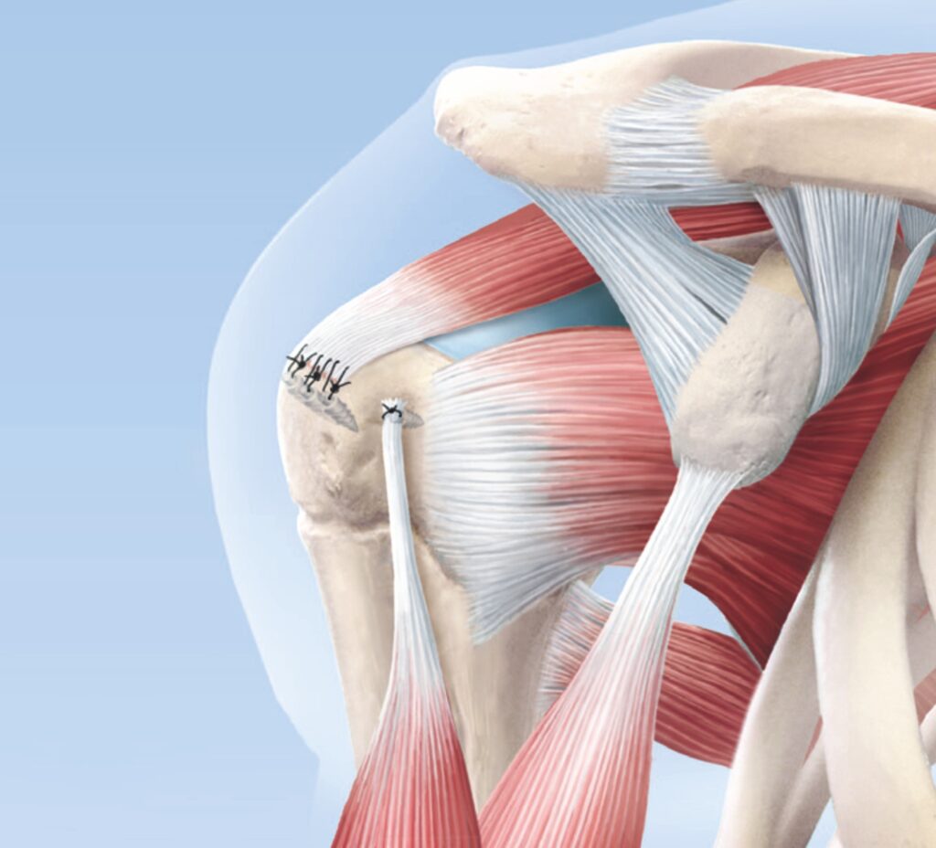 Schulter – Rotatorenmanschette – GZW